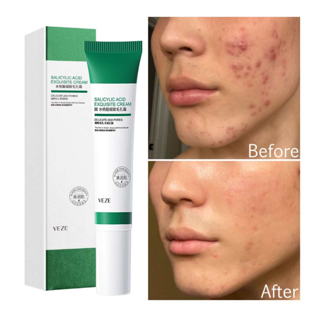 Crema cicatrizante antiacné con acido salicílico Venzen - Kroma Space